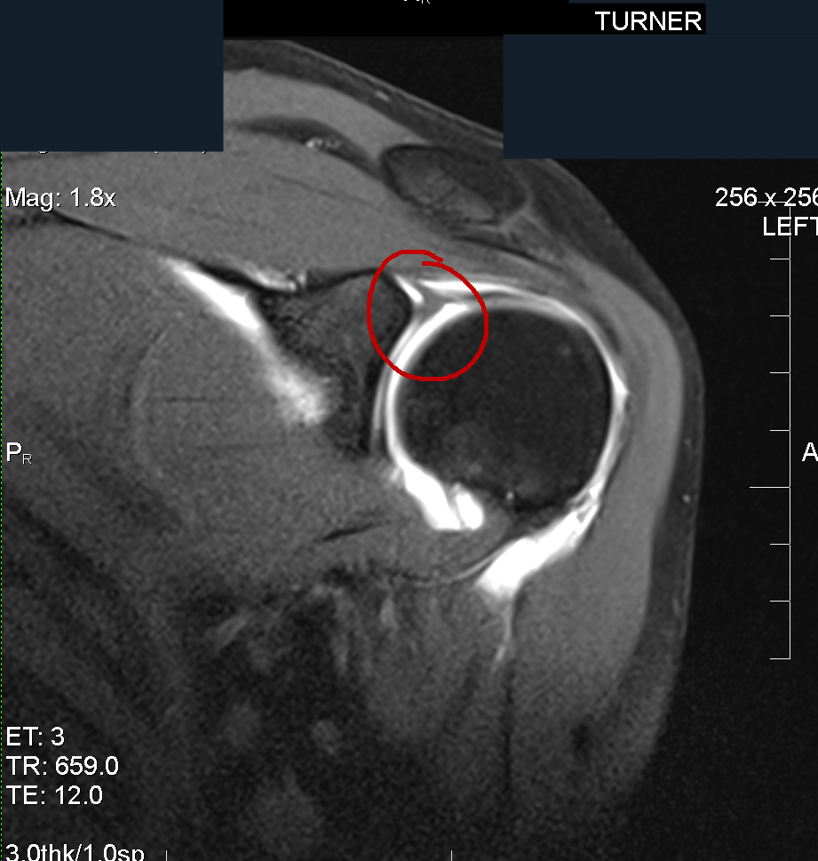 I Have A SLAP Tear And I Could Use Your Help Getting Surgery And 